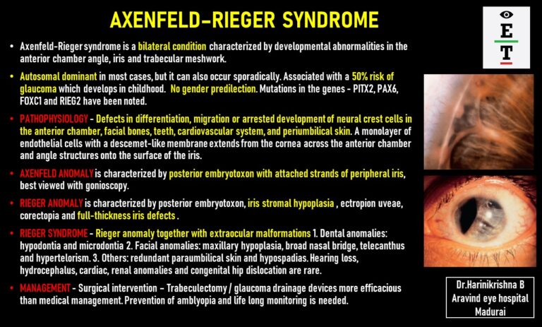 Axenfeld–Rieger Syndrome - EyeToday