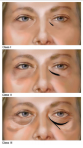 Tearful Tear Trough: Anatomy, Grading and Management. - EyeToday