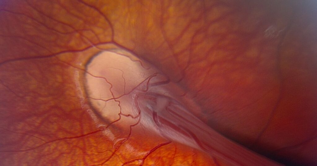 E Notes - EyeToday
